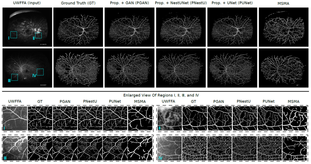 Deep Retinal Vessel Segmentation For Fluorescein Angiography (FA ...